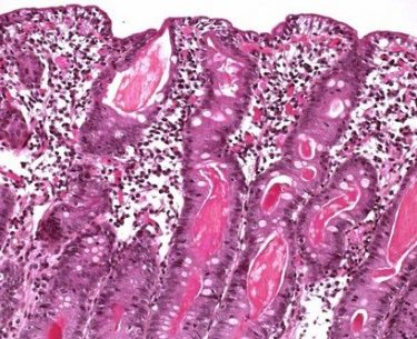 Peritonitlerin tanı ve tedavisi