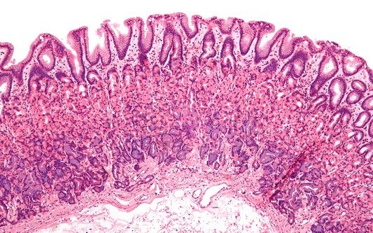 Peptik ülser tanı ve tedavisi