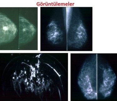 Meme kanseri tanı ve tedavisi