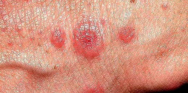 Eritema Multiforme nedir? Nedenleri, belirtileri ve tedavisi