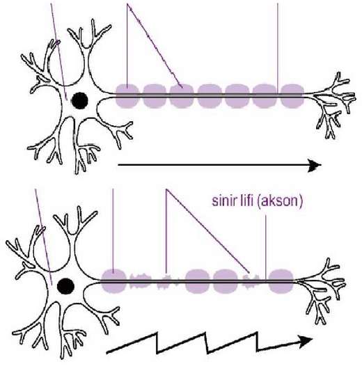 Multiple Skleroz (MS) nedir? Belirtileri ve yeni tedavi seçenekleri