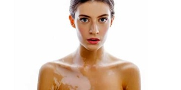 Vitiligo Nedir? Belirtileri, Teşhisi ve Tedavi Yöntemleri