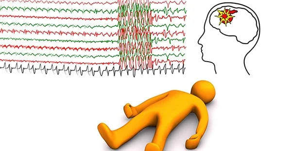 Epilepsi Nedir EPİLEPSİ NEDİR, BELİRTİLERİ NELERDİR? UZMANI