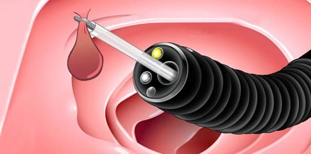 Kolonoskopi nedir? Nasıl yapılır? Kolonoskopinin riskleri nelerdir?