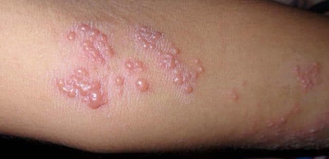 Zona nedir, neden olur? Zonanın belirtileri ve tedavisi