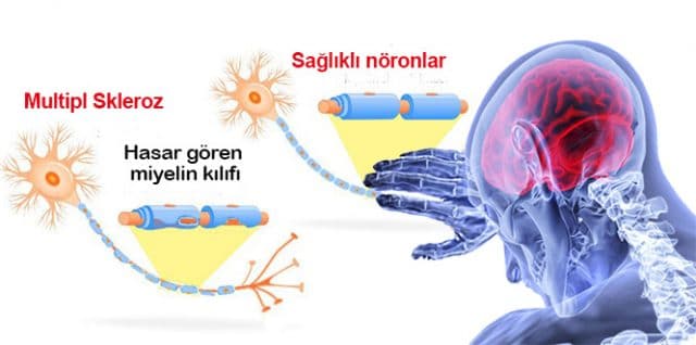 Multipl Skleroz tedavisi ve MS hastalığı ile yaşama rehberi