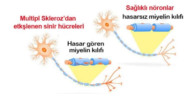 Multipl Skleroz (MS) hastalığı neden olur? Belirtileri ve tedavisi