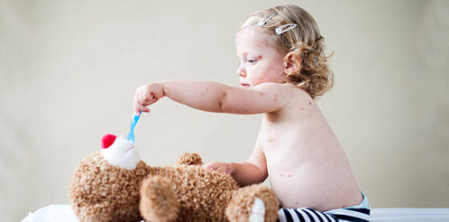 İsilik nedir, neden olur? İsiliğe ne iyi gelir? Belirtileri ve tedavisi