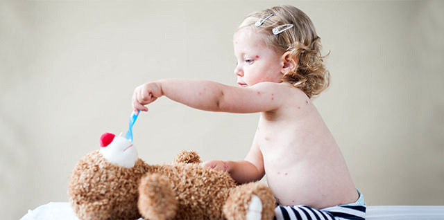 İsilik nedir, neden olur? İsiliğe ne iyi gelir? Belirtileri ve tedavisi