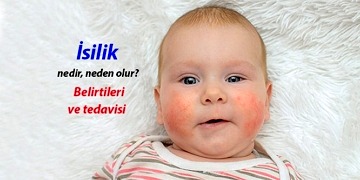 İsilik nedir, neden olur? İsiliğe ne iyi gelir? Belirtileri ve tedavisi