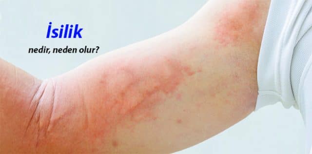 İsilik nedir, neden olur? İsiliğe ne iyi gelir? Belirtileri ve tedavisi