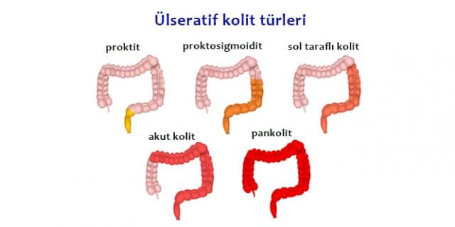 Ülseratif Kolit nedir? Neden olur? Belirtileri ve tedavisi