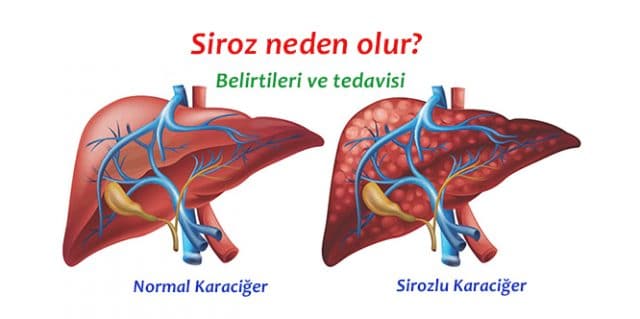 Karaciğer Hastalıkları | Medikal Akademi
