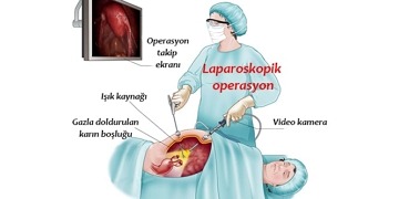 Laparoskopi nedir, neden yapılır? Ameliyatı ne kadar sürer?
