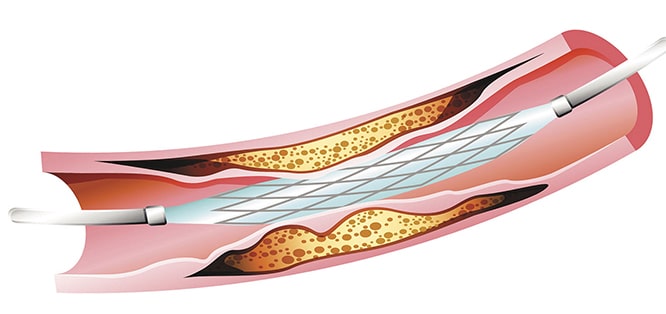 Stent nedir, nasıl takılır? Hangi hastalara uygulanır? Riskleri nelerdir?