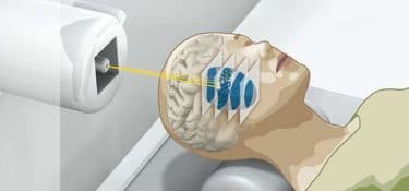 Radyoterapi nedir? Kanser tedavisinde nasıl uygulanır? Yan etkileri