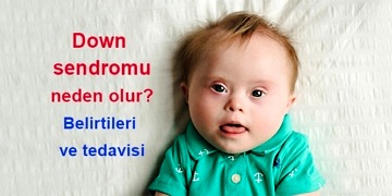 Down sendromu nedir, neden olur? Belirtileri ve tedavisi