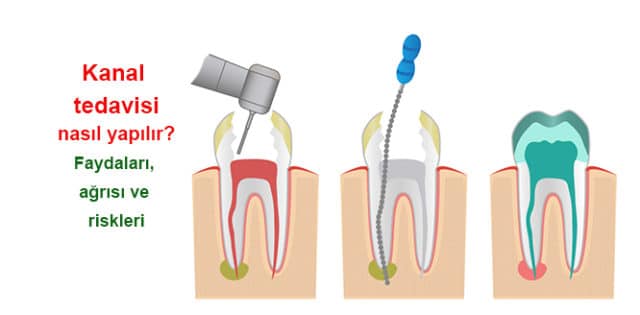 Kanal tedavisi nedir, nasıl yapılır? Tedavi sonrası ağrı ve riskler