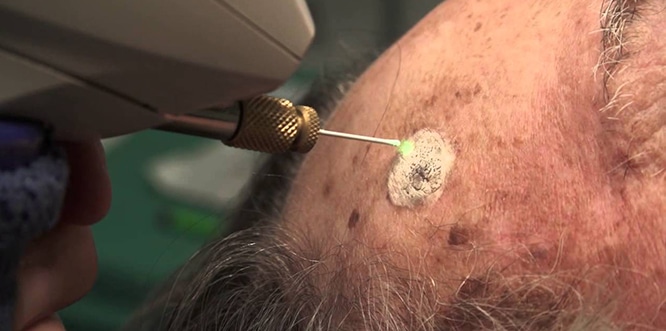 Kriyoterapi nedir? Nasıl uygulanır? Avantaj ve riskleri