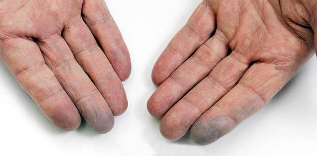 Raynaud fenomeni nedir? Reyno hastalığının belirtileri ve tedavisi