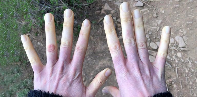 Raynaud fenomeni nedir? Reyno hastalığının belirtileri ve tedavisi