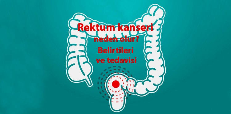 Rektum kanseri neden olur? Belirtileri ve tedavi seçenekleri
