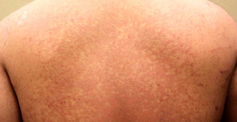Cilt mantarı nedir, neden olur? Türleri, belirtileri ve tedavisi