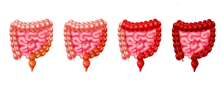 Kolit nedir? Neden olur? Kolitin belirtileri ve tedavisi