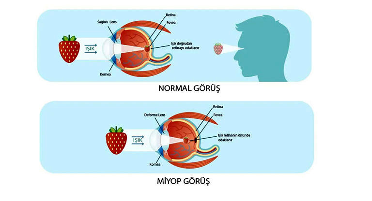 Miyop nedir? Neden olur? Belirtileri ve tedavi seçenekleri